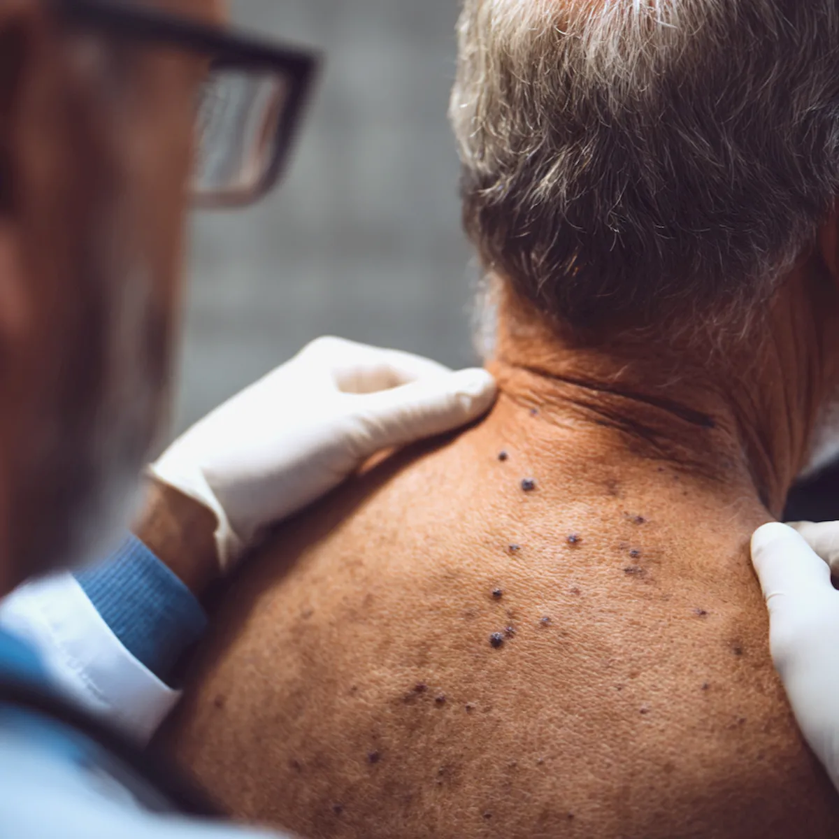 Skin Cancer Screening | Skin Cancer Screening Near Me | Colleyville, TX